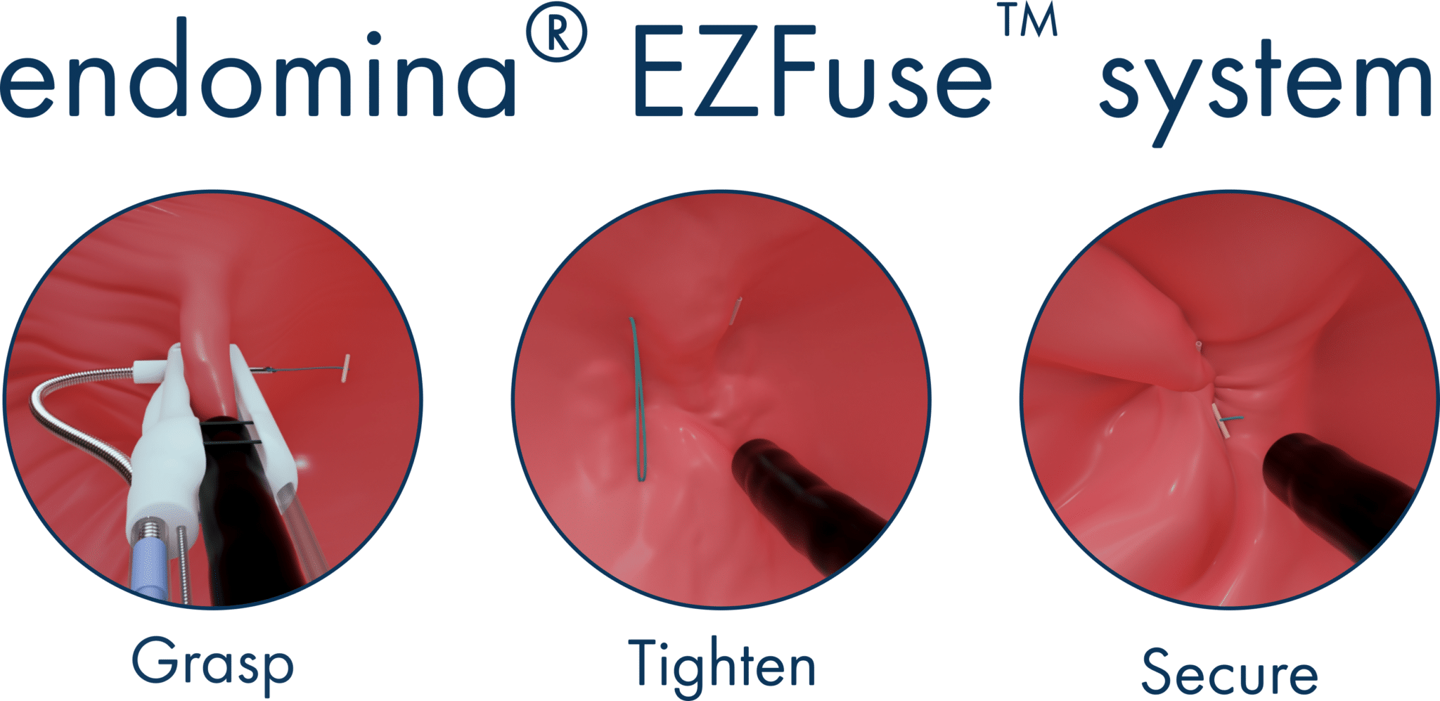 Endo Tools Therapeutics Receives FDA 510(k) Clearance for Next ...